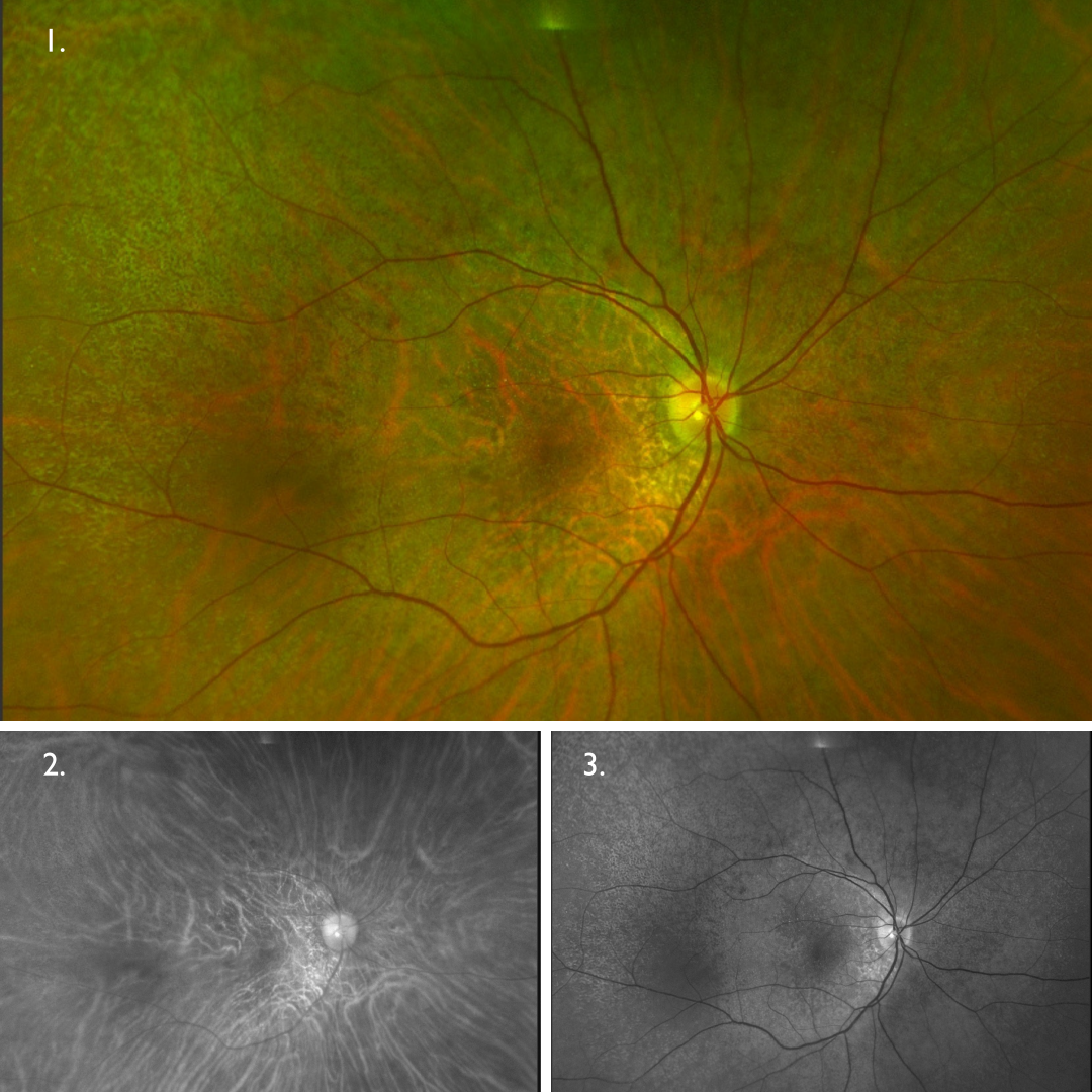 Congenital Stationary Nightblindness (CSNB) - Extract from CFEH Atlas ...