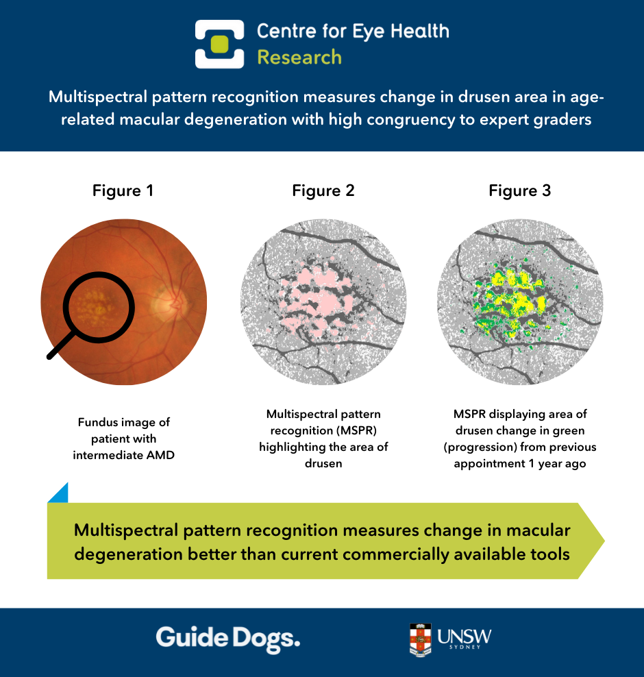 Multispectral pattern recognition better way to measure AMD changes ...