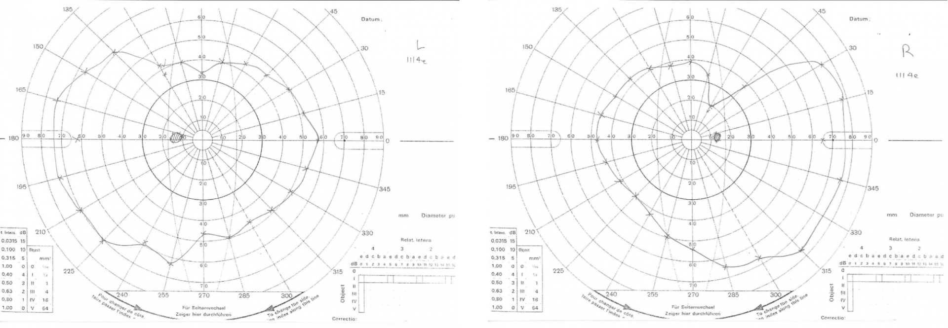 Retinitis Pigmentosa (Extract from the CFEH Atlas) - Centre for Eye Health