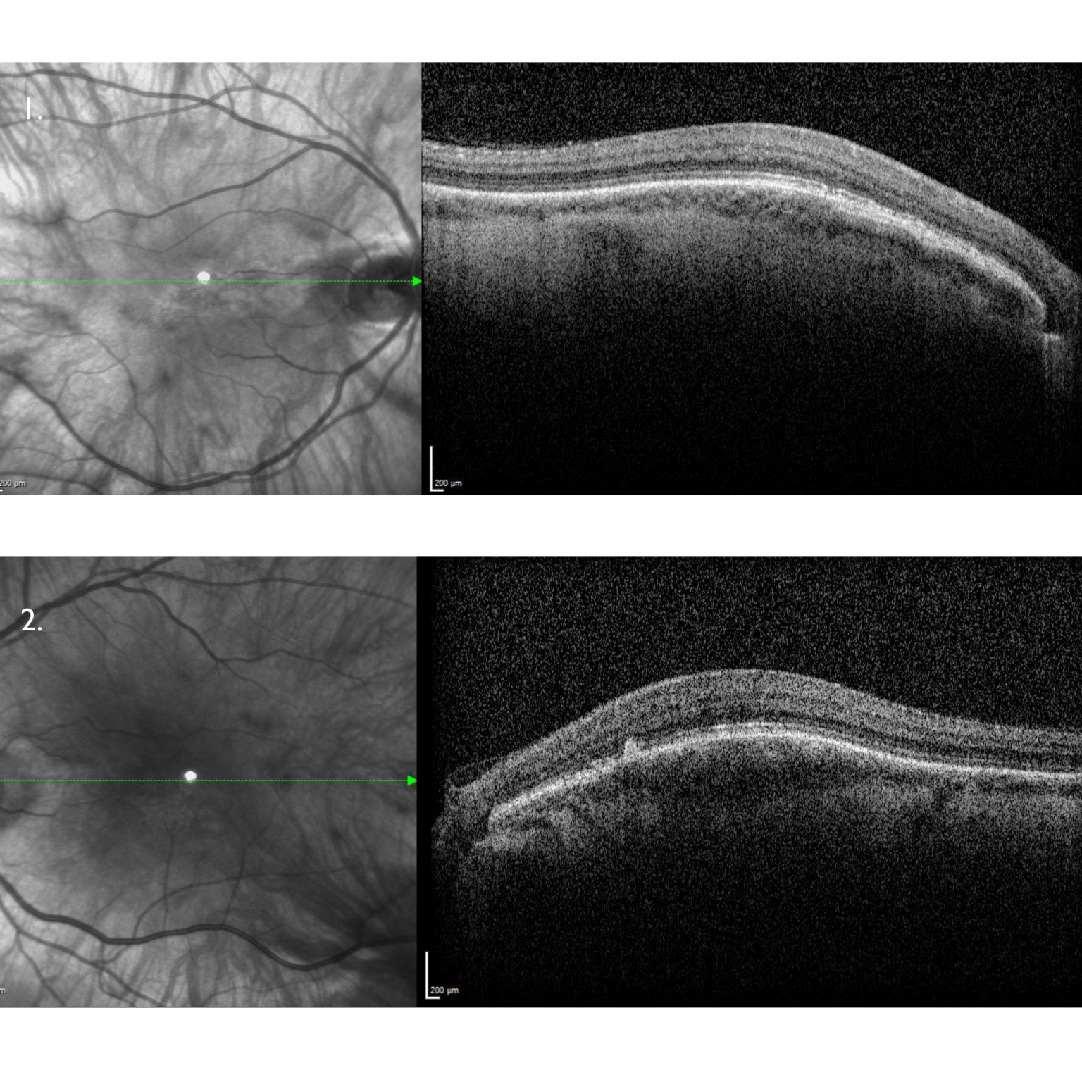 Ocular Albinism - Centre for Eye Health