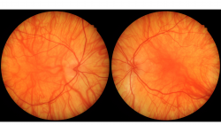 Ocular Albinism - Centre for Eye Health