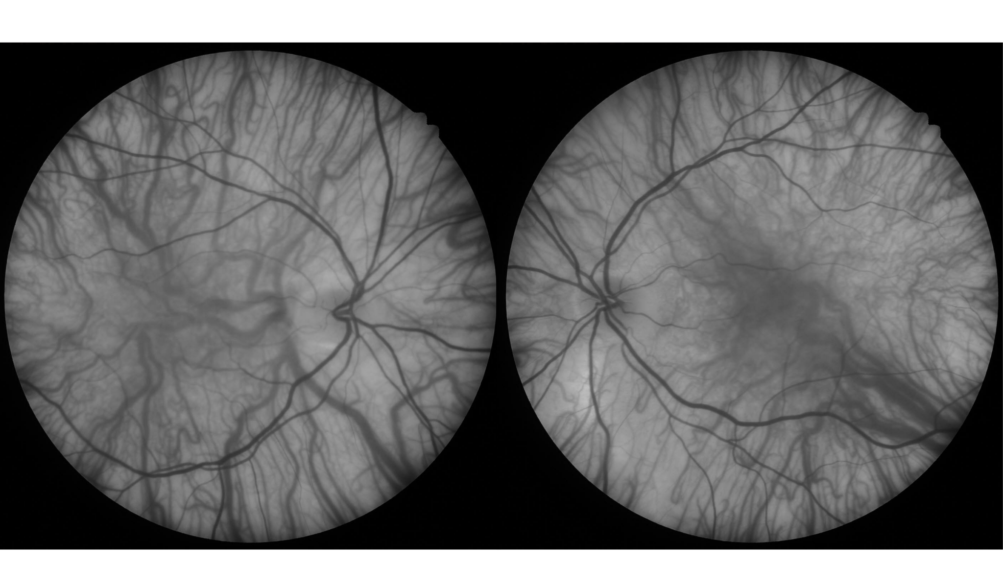 Ocular Albinism - Centre for Eye Health