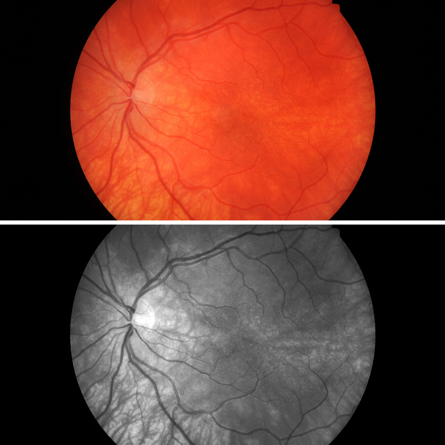 Ocular Albinism - Centre for Eye Health