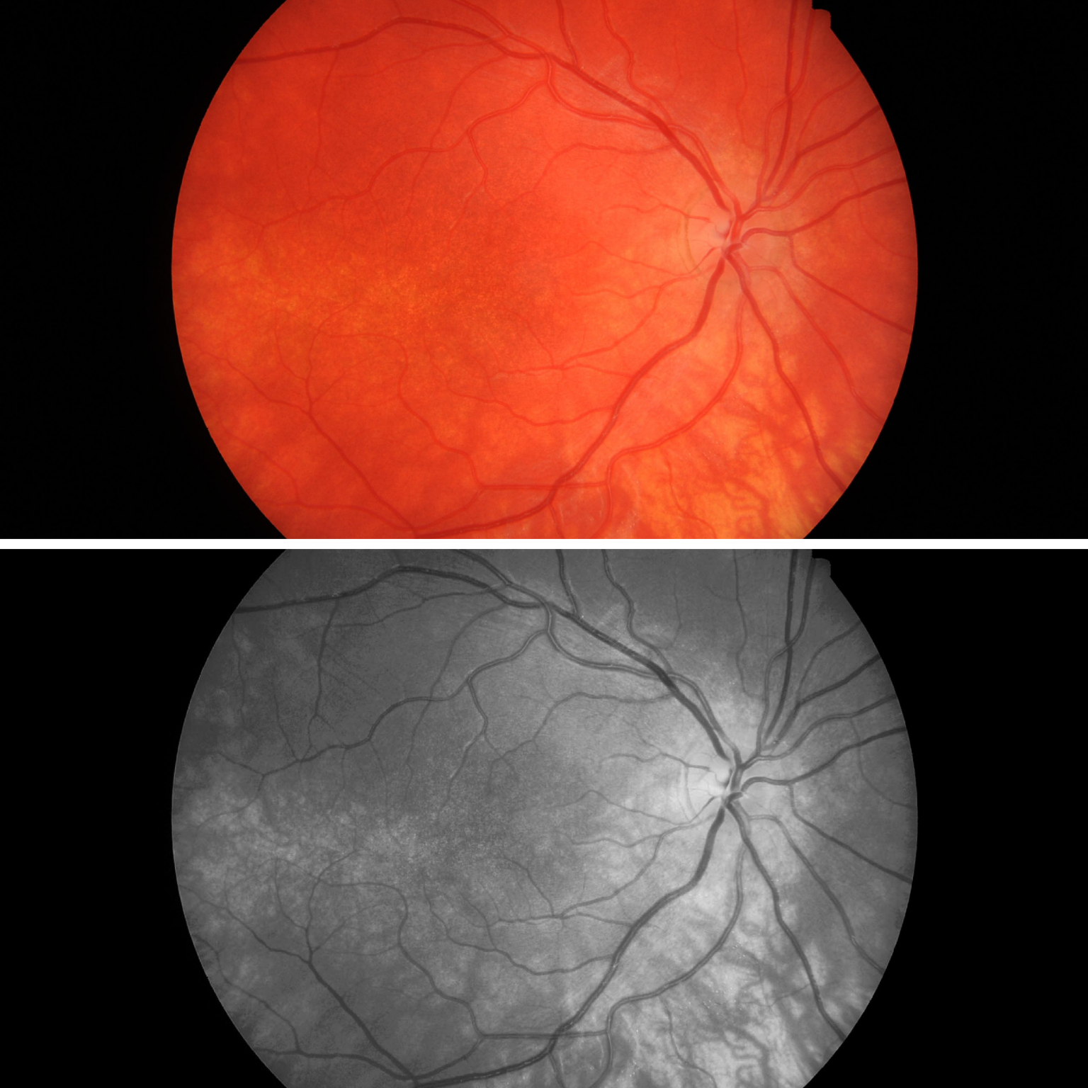 Ocular Albinism - Centre for Eye Health