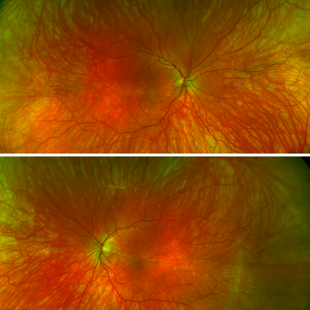 Ocular Albinism - Centre for Eye Health