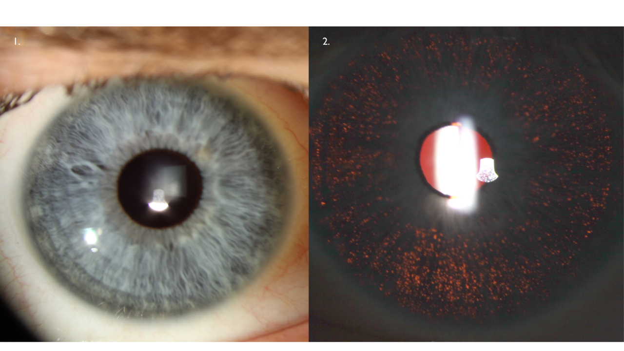 Ocular Albinism - Centre for Eye Health