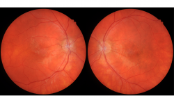 Ocular Albinism - Centre for Eye Health