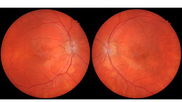 Ocular Albinism - Centre for Eye Health