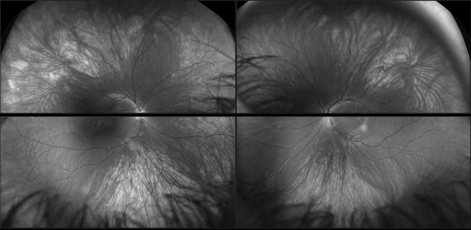 Ocular Albinism - Centre for Eye Health