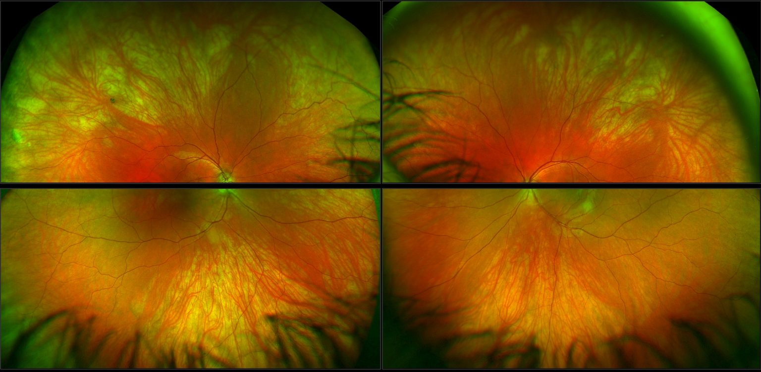 Ocular Albinism - Centre for Eye Health