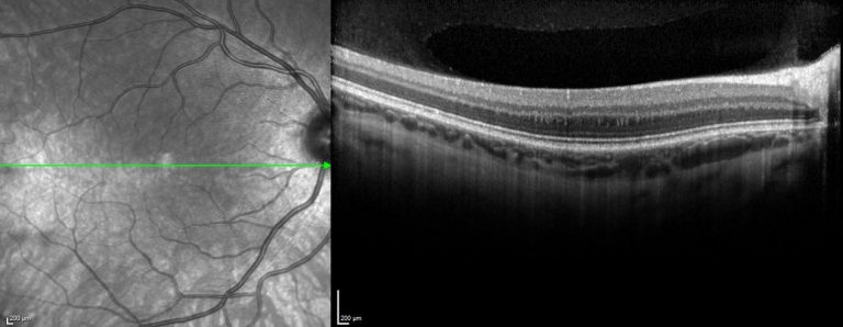 Ocular Albinism - Centre for Eye Health