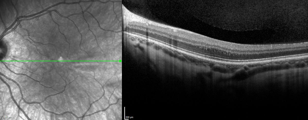Ocular Albinism - Centre for Eye Health