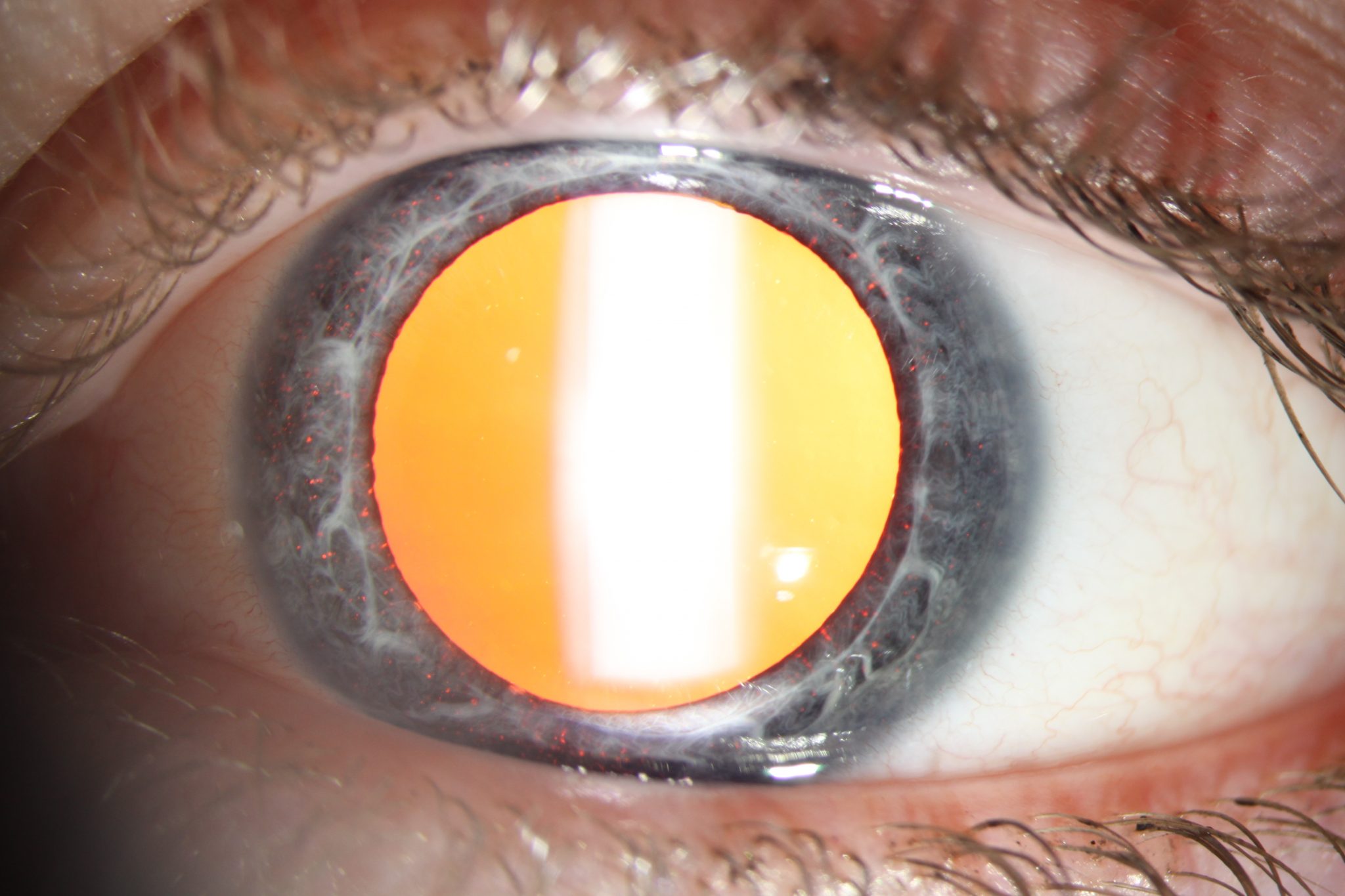Ocular Albinism - Centre for Eye Health